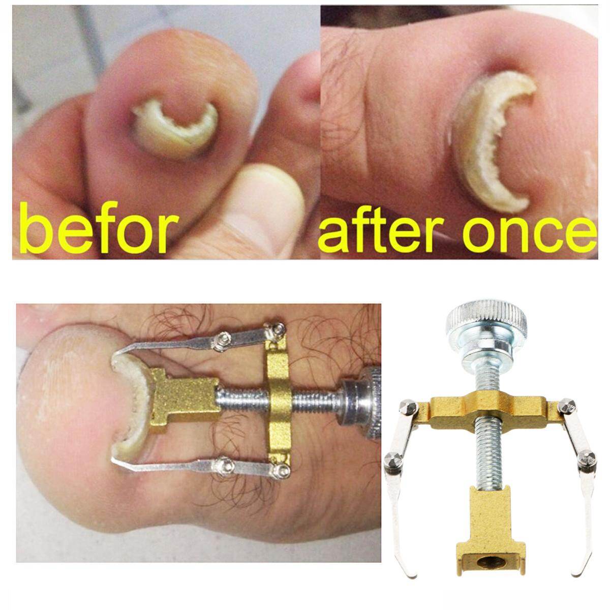 Fijador de uñas del dedo pie encarnado Pedicura Recuperación GENERICO ...