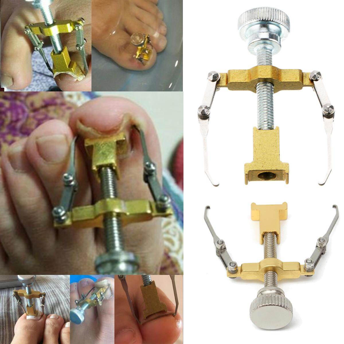 Fijador de uñas del dedo pie encarnado Pedicura Recuperación GENERICO ...